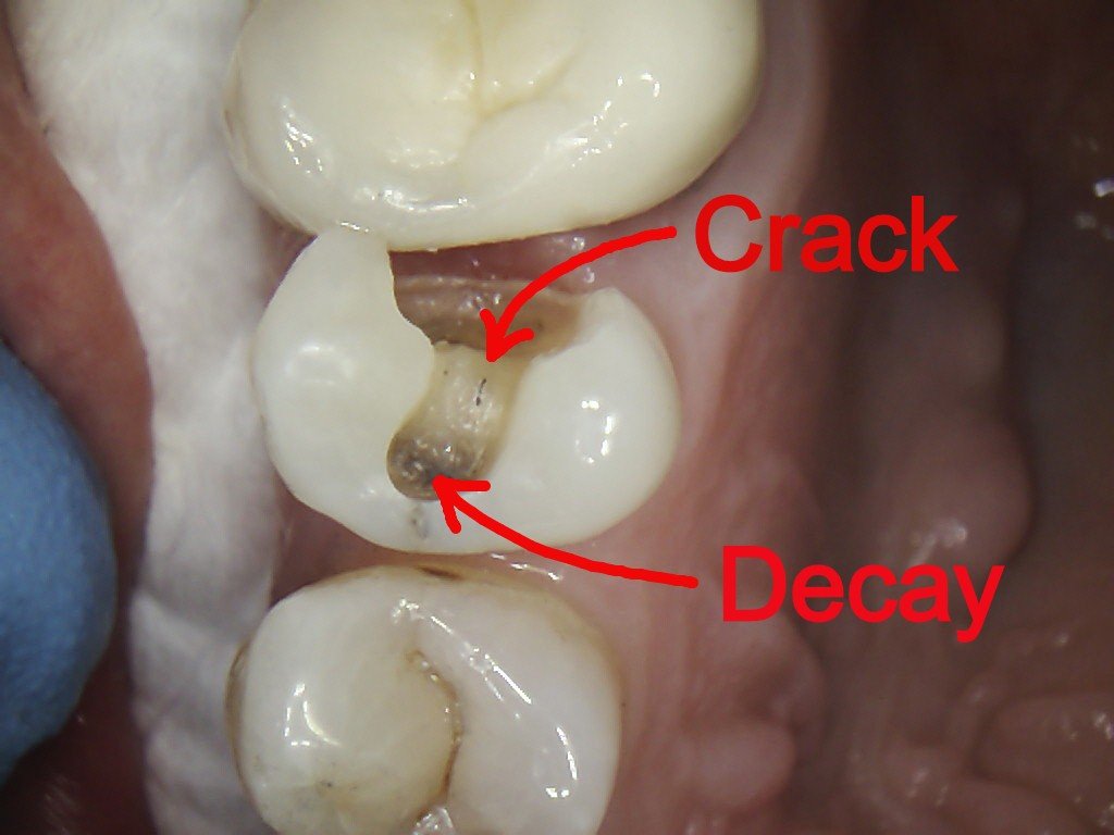 Fibre-Reinforced Composite Fillings | Discover Dental Wellington