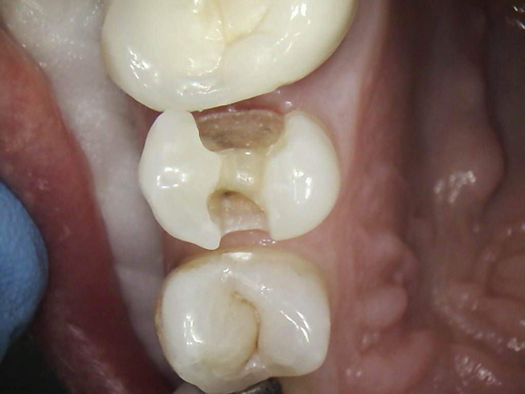 Fibre-Reinforced Composite Fillings | Discover Dental Wellington