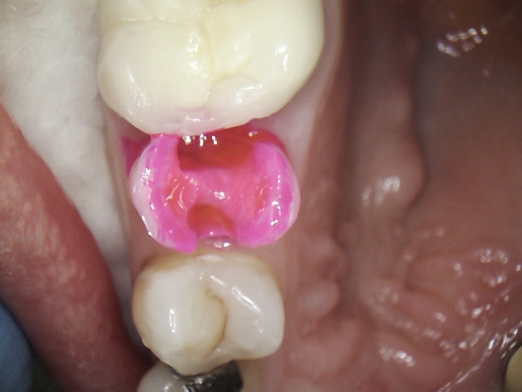 Fibre-Reinforced Composite Fillings | Discover Dental Wellington