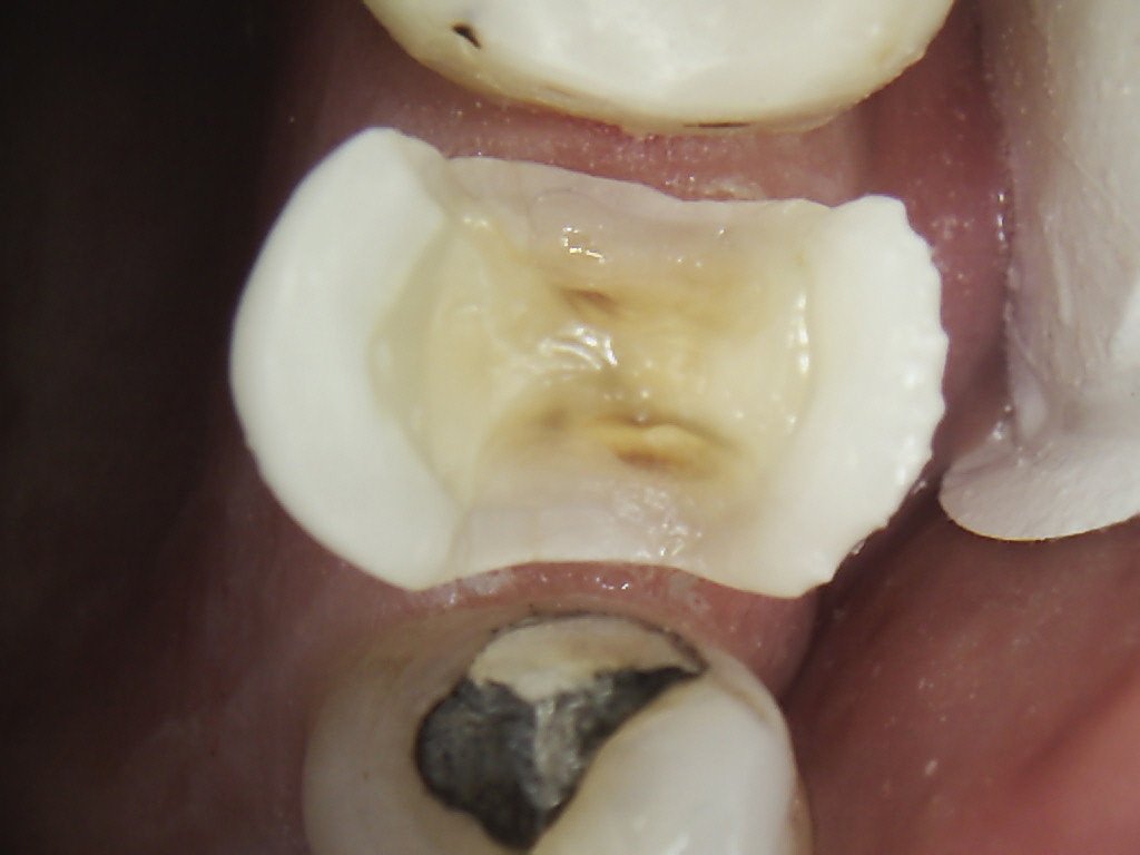 Fibre-Reinforced Composite Fillings | Discover Dental Wellington