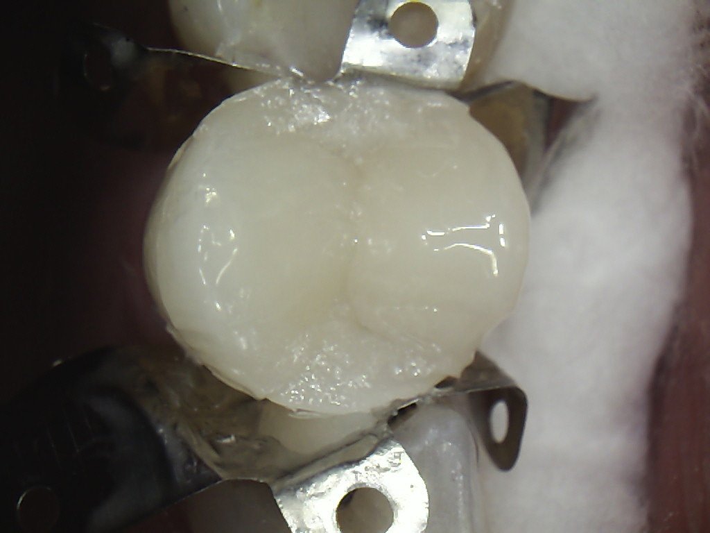 Fibre-Reinforced Composite Fillings | Discover Dental Wellington