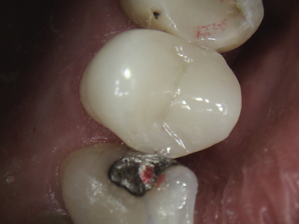 Fibre-Reinforced Composite Fillings | Discover Dental Wellington