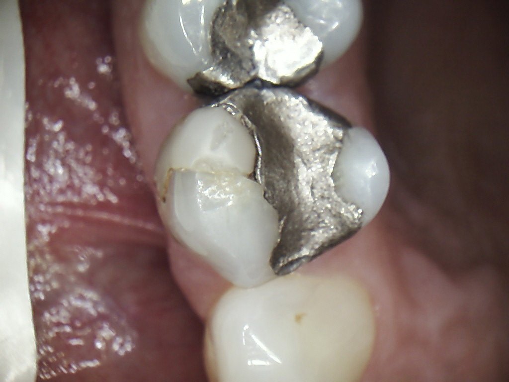 Fibre-Reinforced Composite Fillings | Discover Dental Wellington