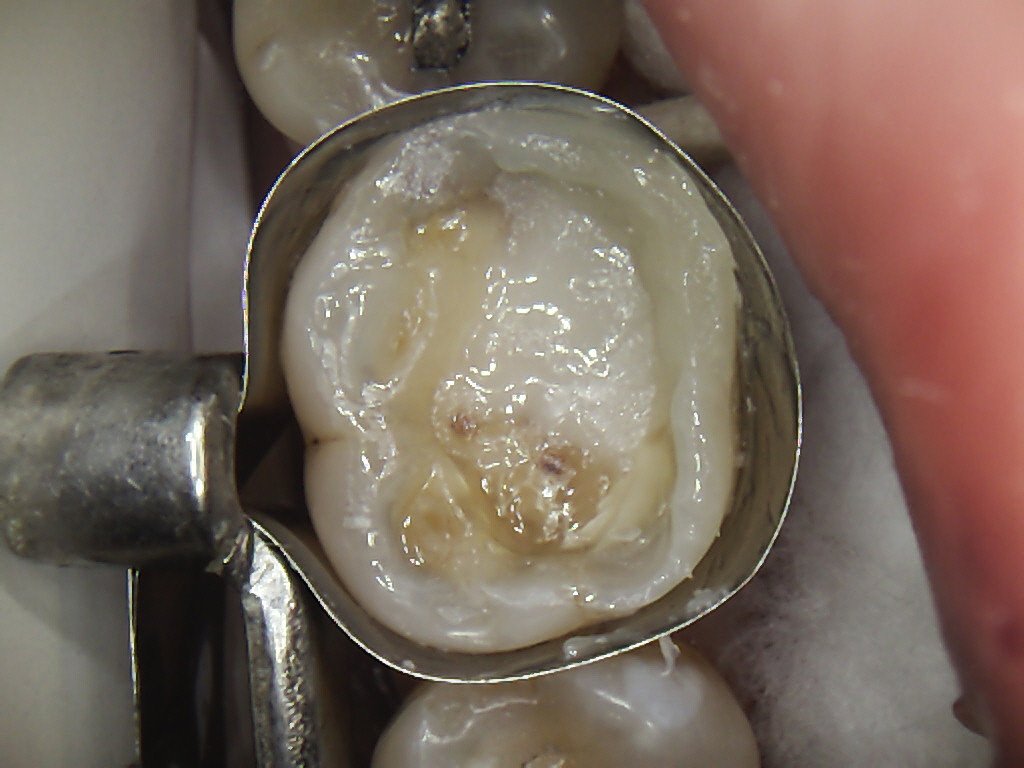 Fibre-Reinforced Composite Fillings | Discover Dental Wellington