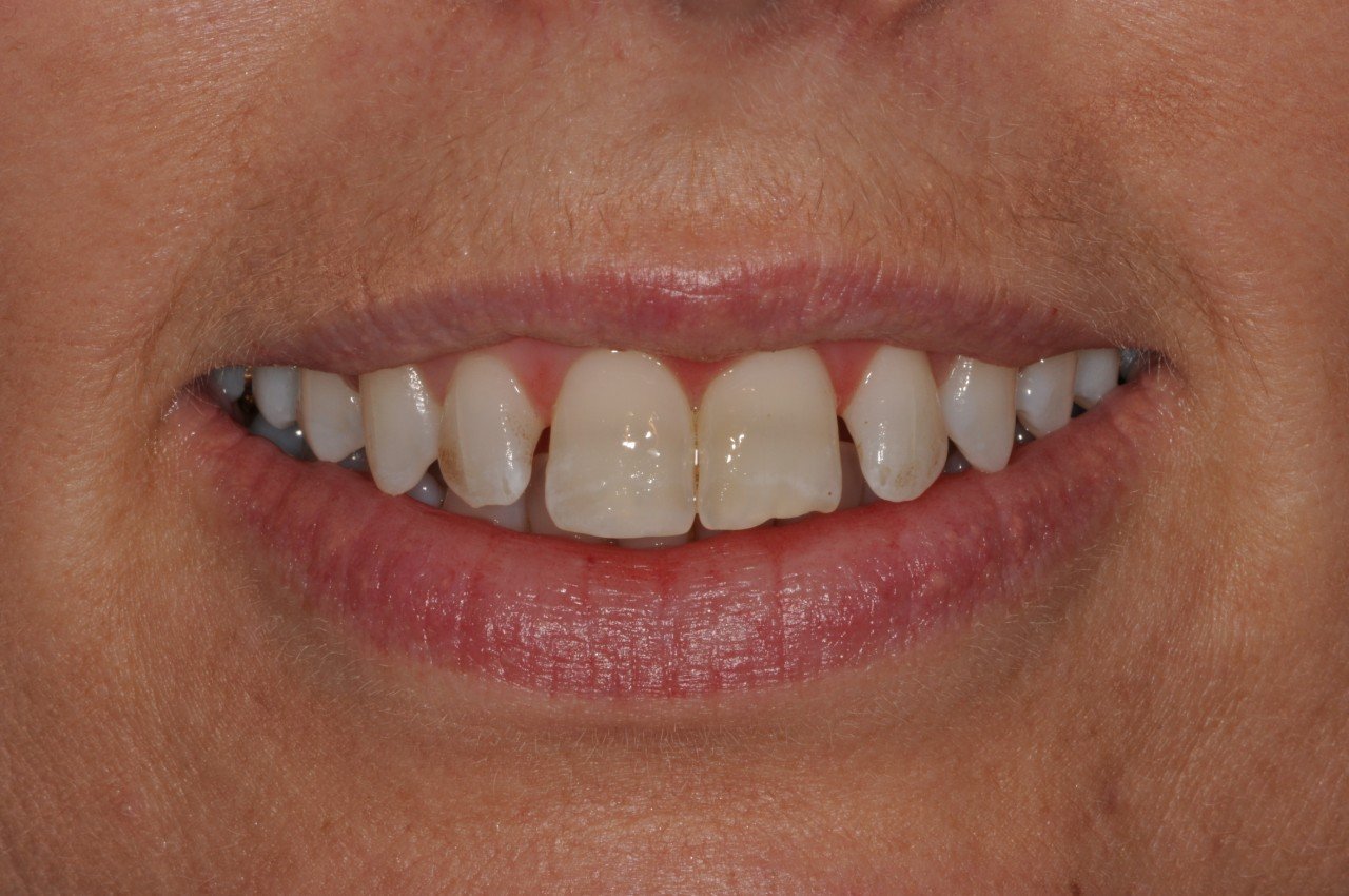 Composite Veeners | Discover Dental Wellington