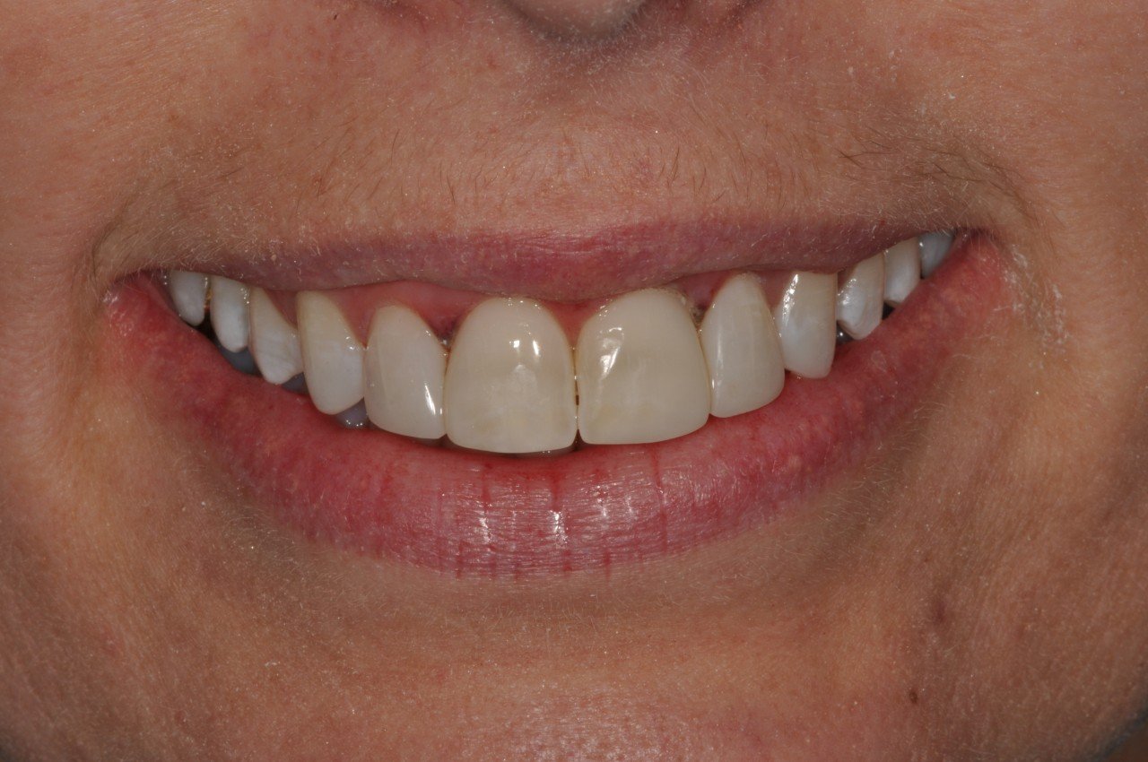 Composite Veeners | Discover Dental Wellington