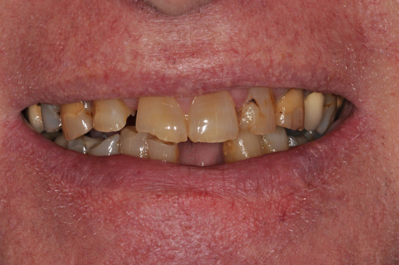 Composite Veeners | Discover Dental Wellington