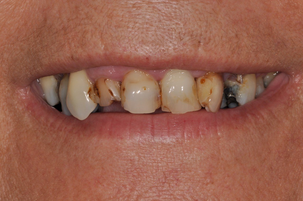 Composite Veeners | Discover Dental Wellington