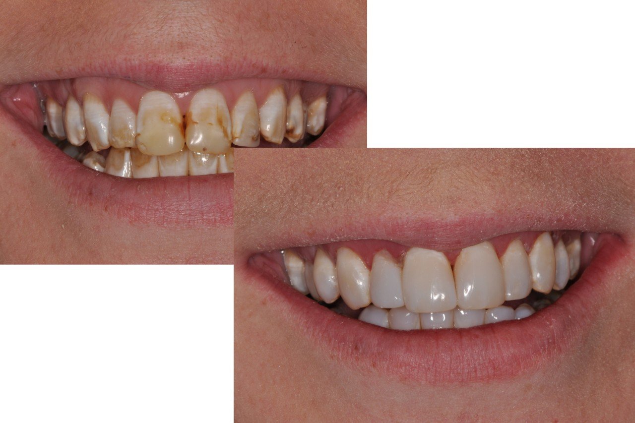 Composite Veeners | Discover Dental Wellington