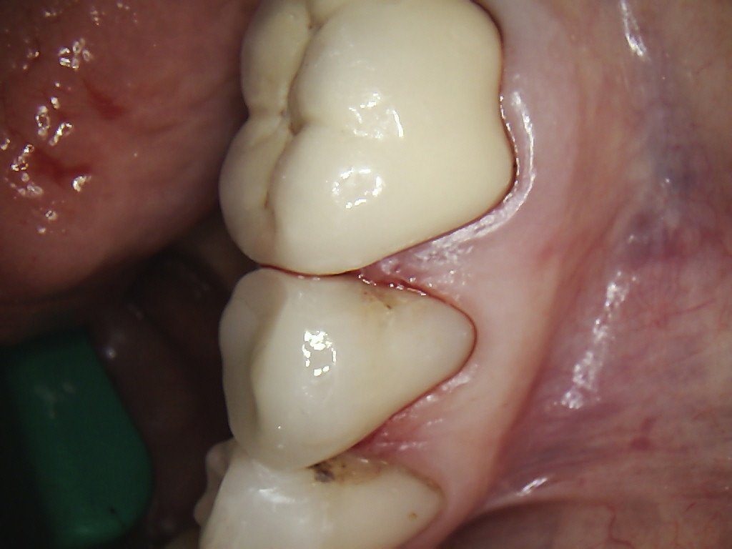 Composite Fillings | Discover Dental Wellington