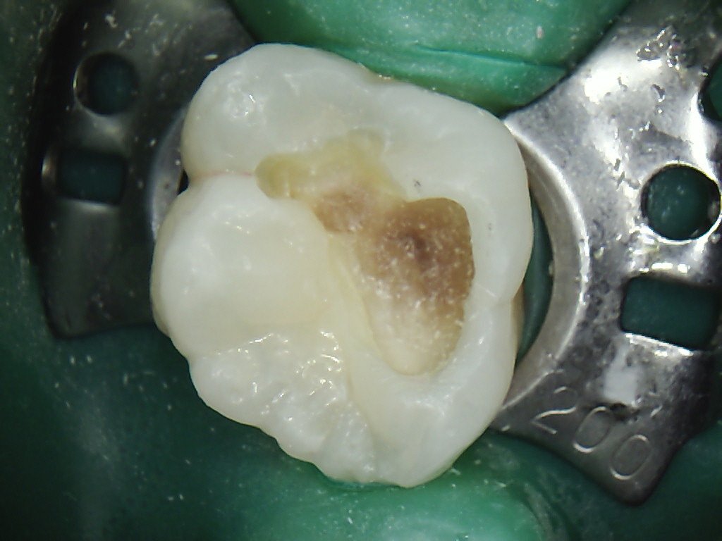 Composite Fillings | Discover Dental Wellington