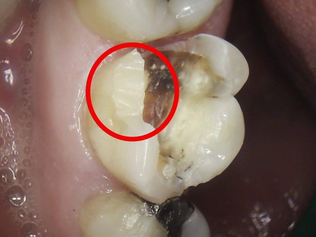 Composite Fillings | Discover Dental Wellington