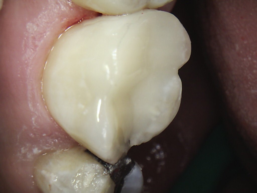 Composite Fillings | Discover Dental Wellington