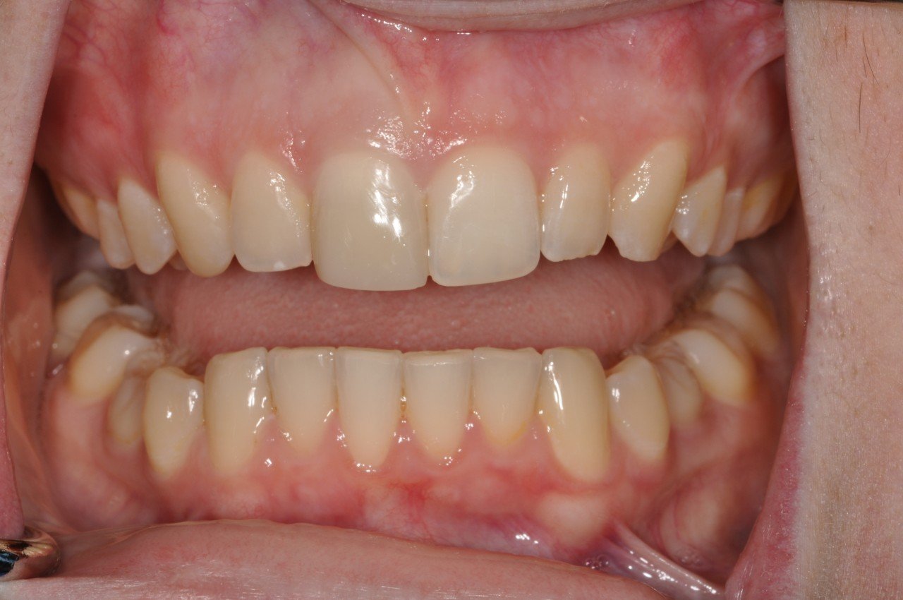 Composite Fillings | Discover Dental Wellington