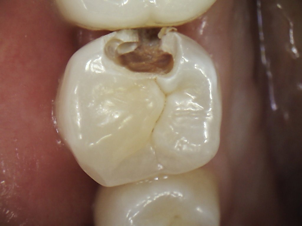 Composite Fillings | Discover Dental Wellington