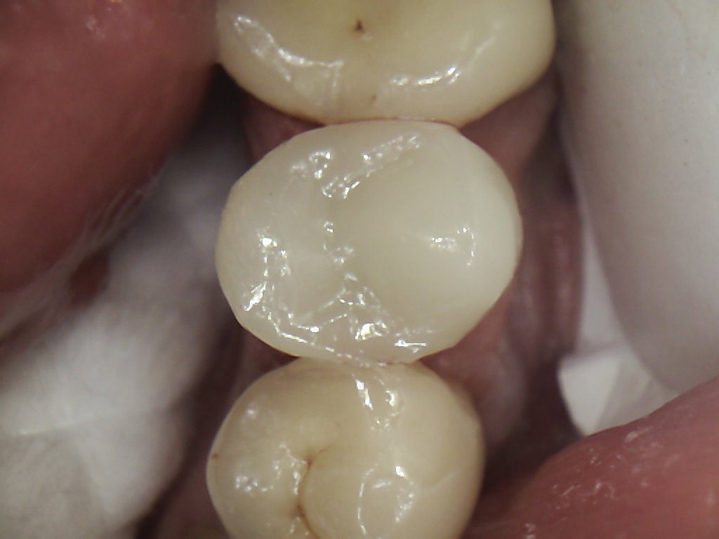 Composite Fillings | Discover Dental Wellington