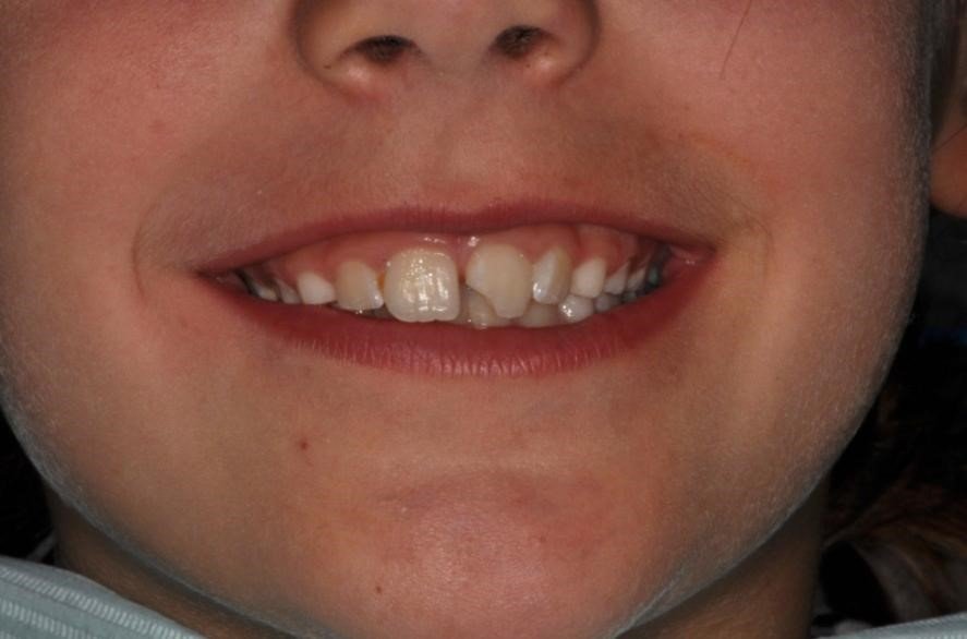 Rebonding Fractured Tooth Fragments | Discover Dental Wellington