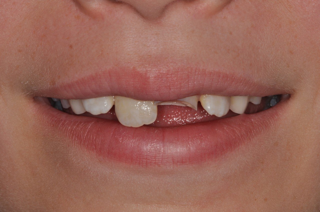 Rebonding Fractured Tooth Fragments | Discover Dental Wellington