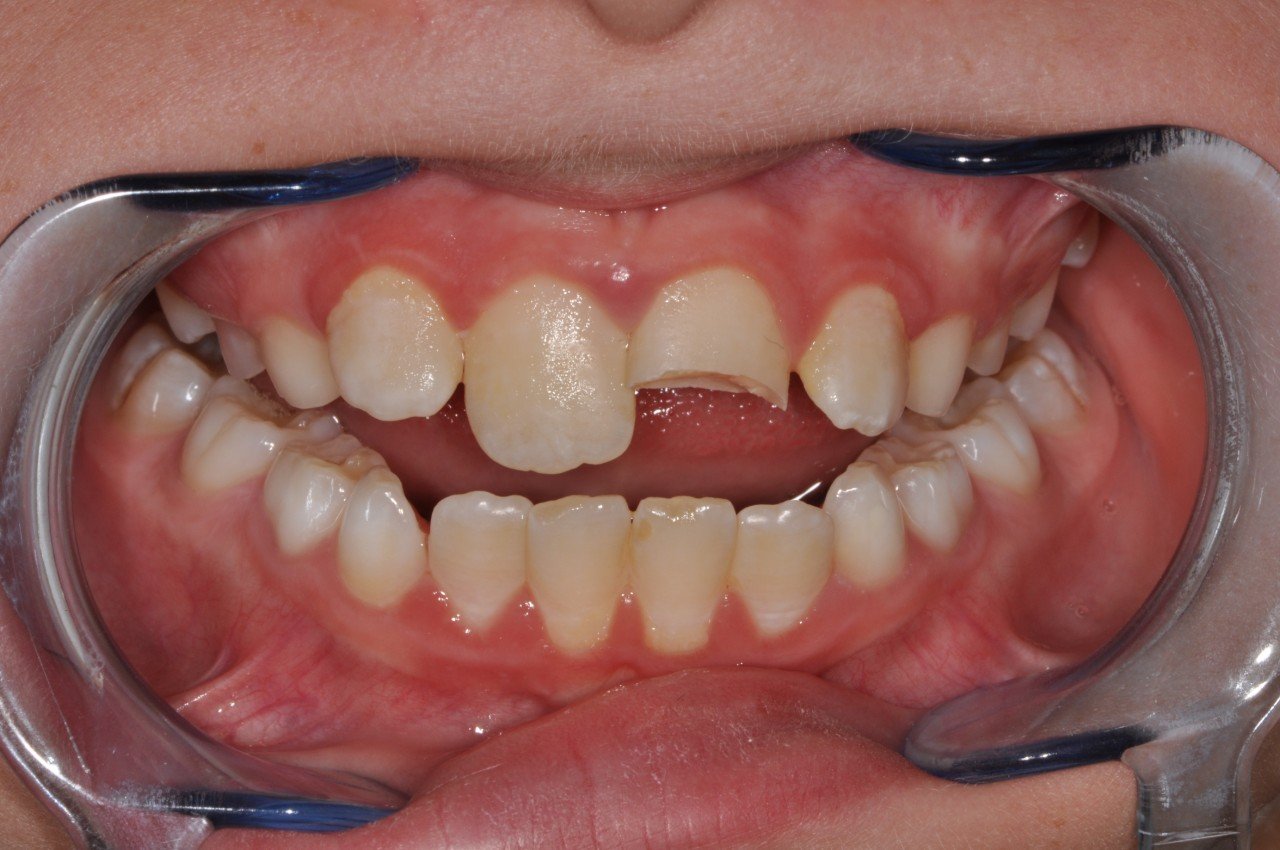 Rebonding Fractured Tooth Fragments | Discover Dental Wellington