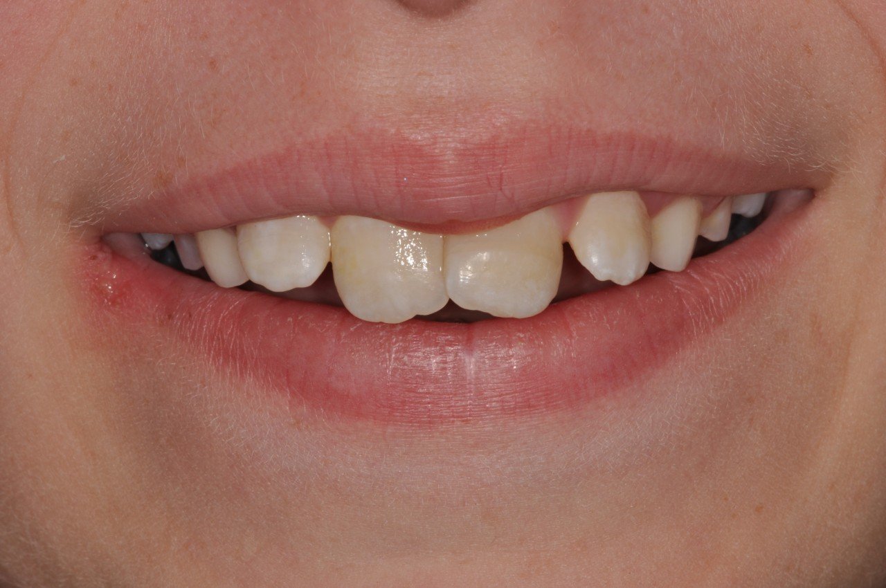 Rebonding Fractured Tooth Fragments | Discover Dental Wellington