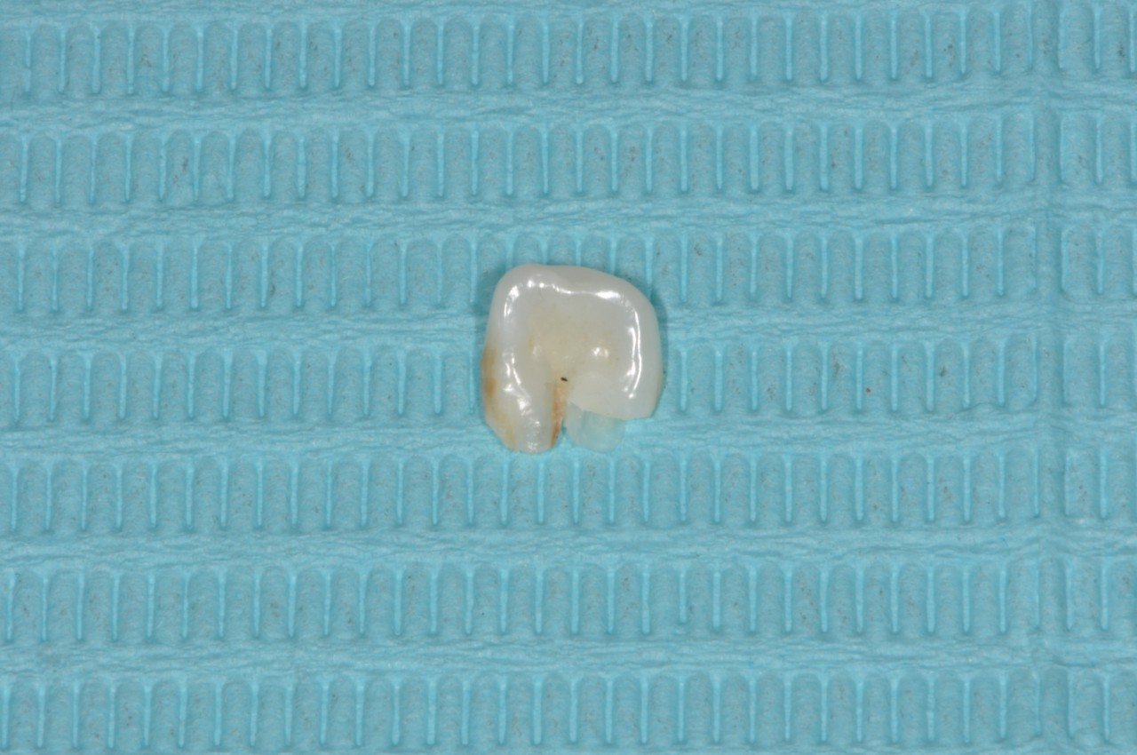 Rebonding Fractured Tooth Fragments | Discover Dental Wellington