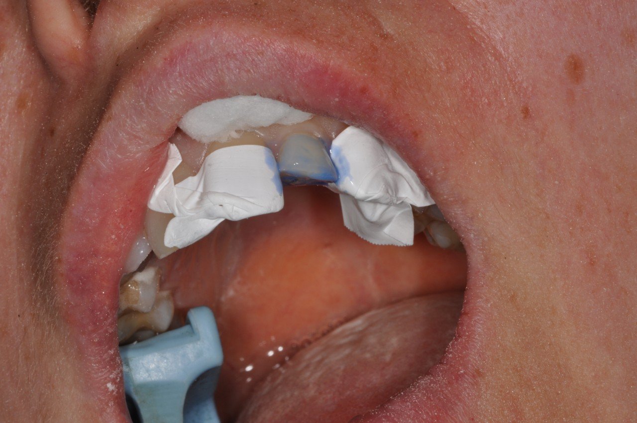 Rebonding Fractured Tooth Fragments | Discover Dental Wellington