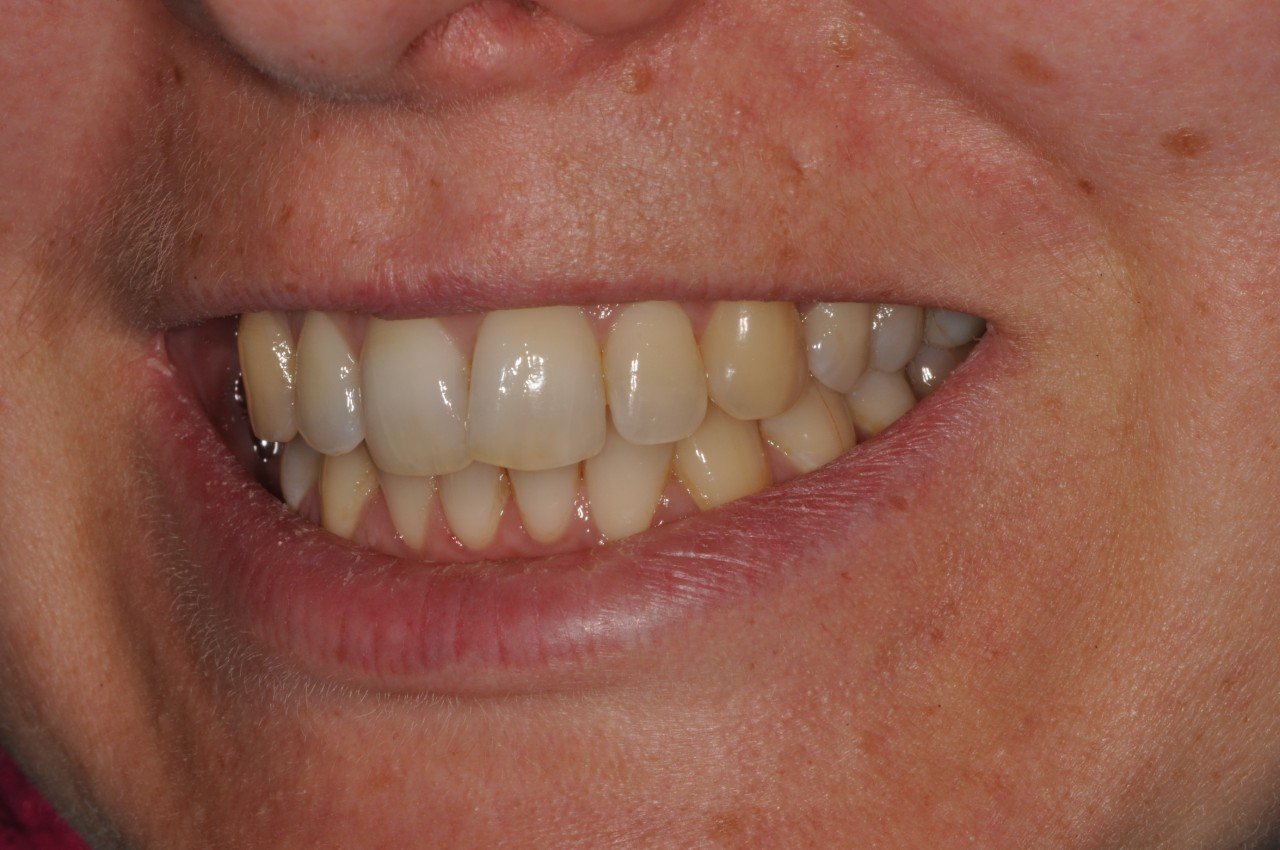 Rebonding Fractured Tooth Fragments | Discover Dental Wellington