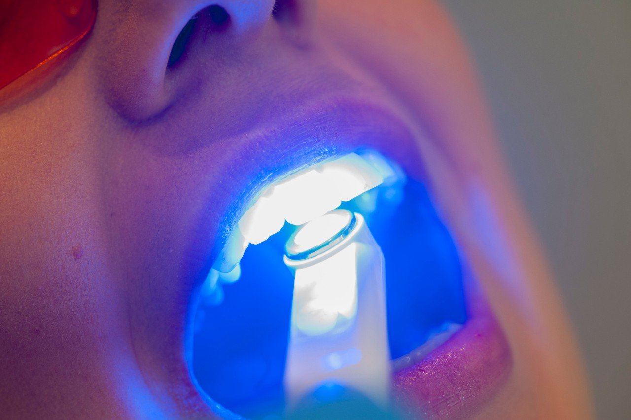 White Filling Options | Discover Dental Wellington