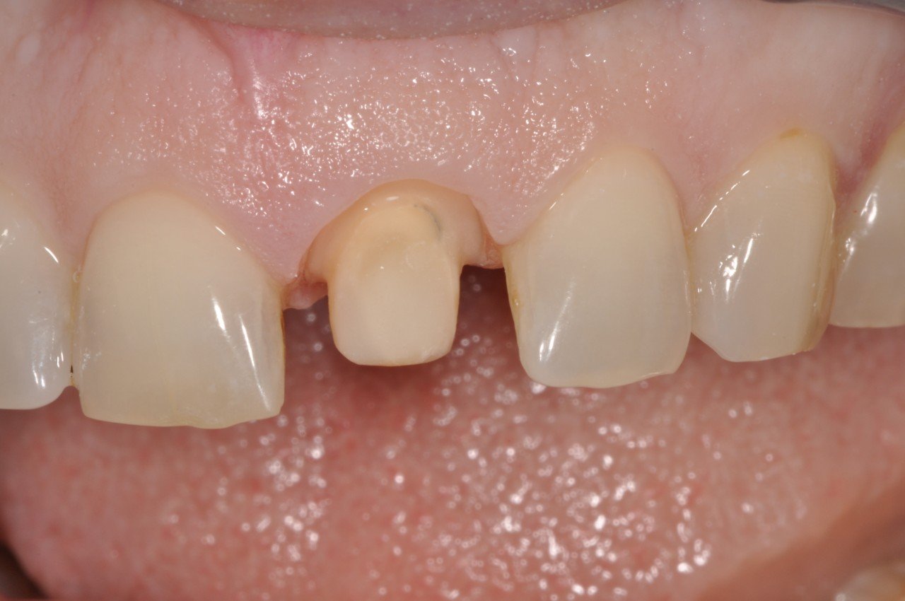 Crowns & Onlays | Discover Dental Wellington