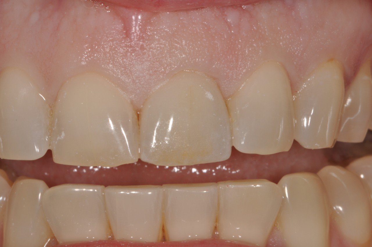 Crowns & Onlays | Discover Dental Wellington