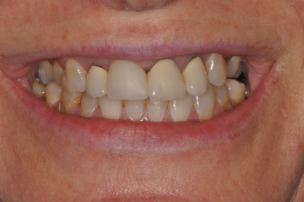 Crowns & Onlays | Discover Dental Wellington