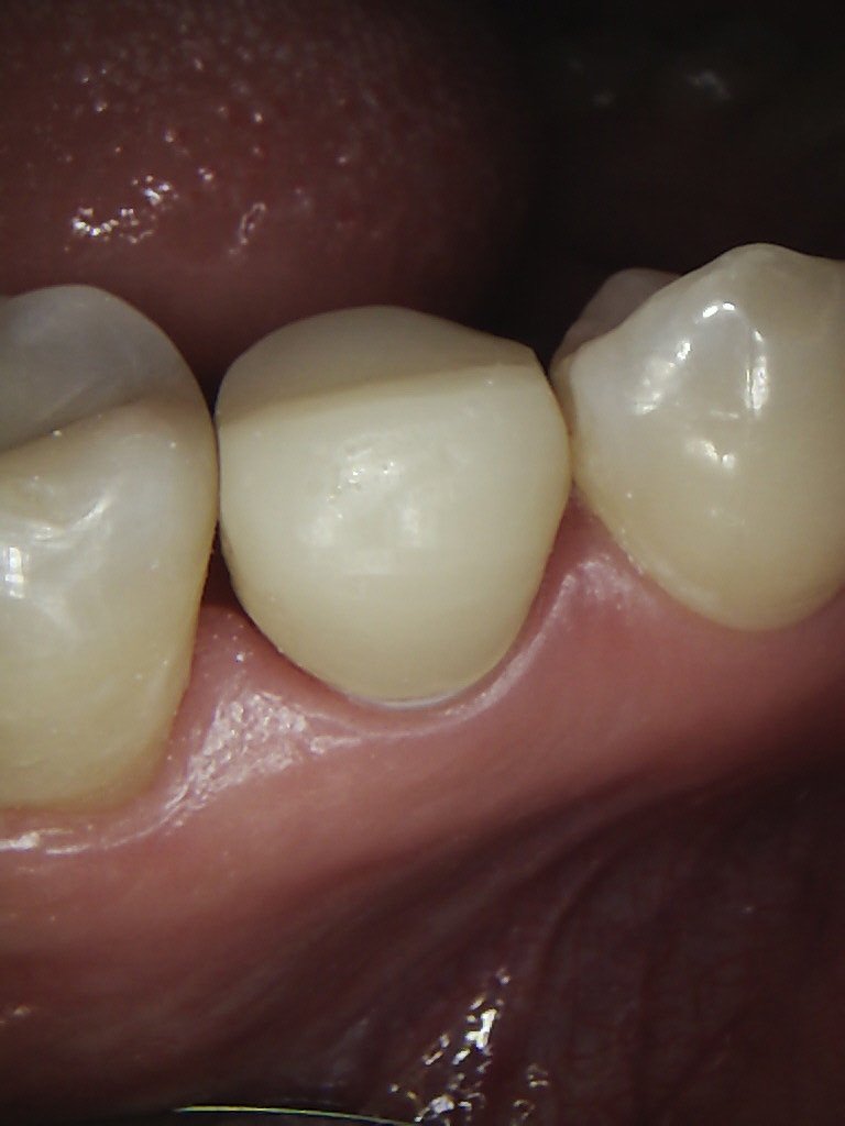 Crowns & Onlays | Discover Dental Wellington