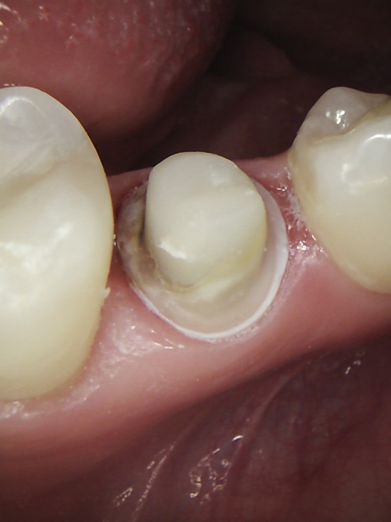 Crowns & Onlays | Greenwood Grincare Wellington Dentists