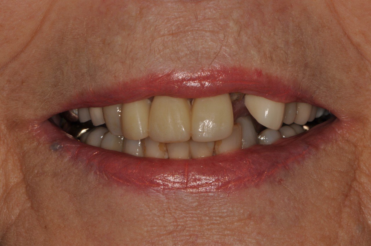 Crowns & Onlays | Discover Dental Wellington