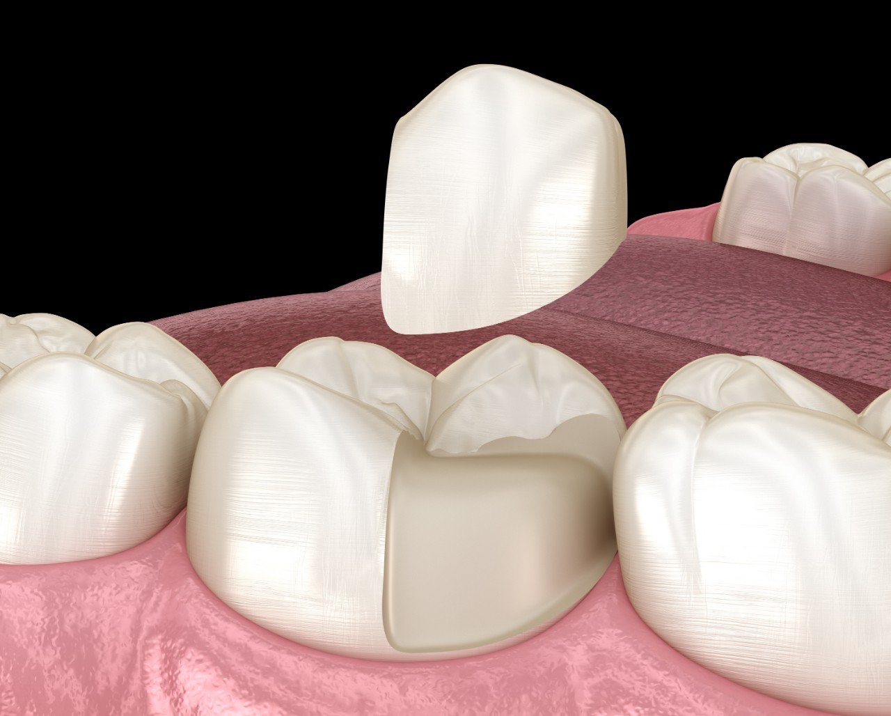 Crowns & Onlays | Discover Dental Wellington