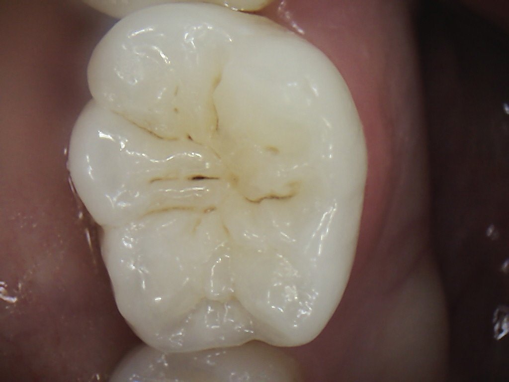 Fissure Protection & PRRs | Discover Dental Wellington