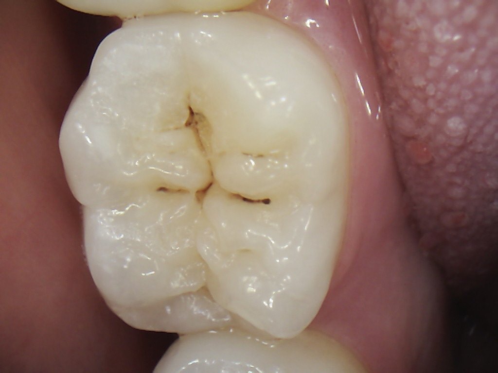 Fissure Protection & PRRs | Discover Dental Wellington