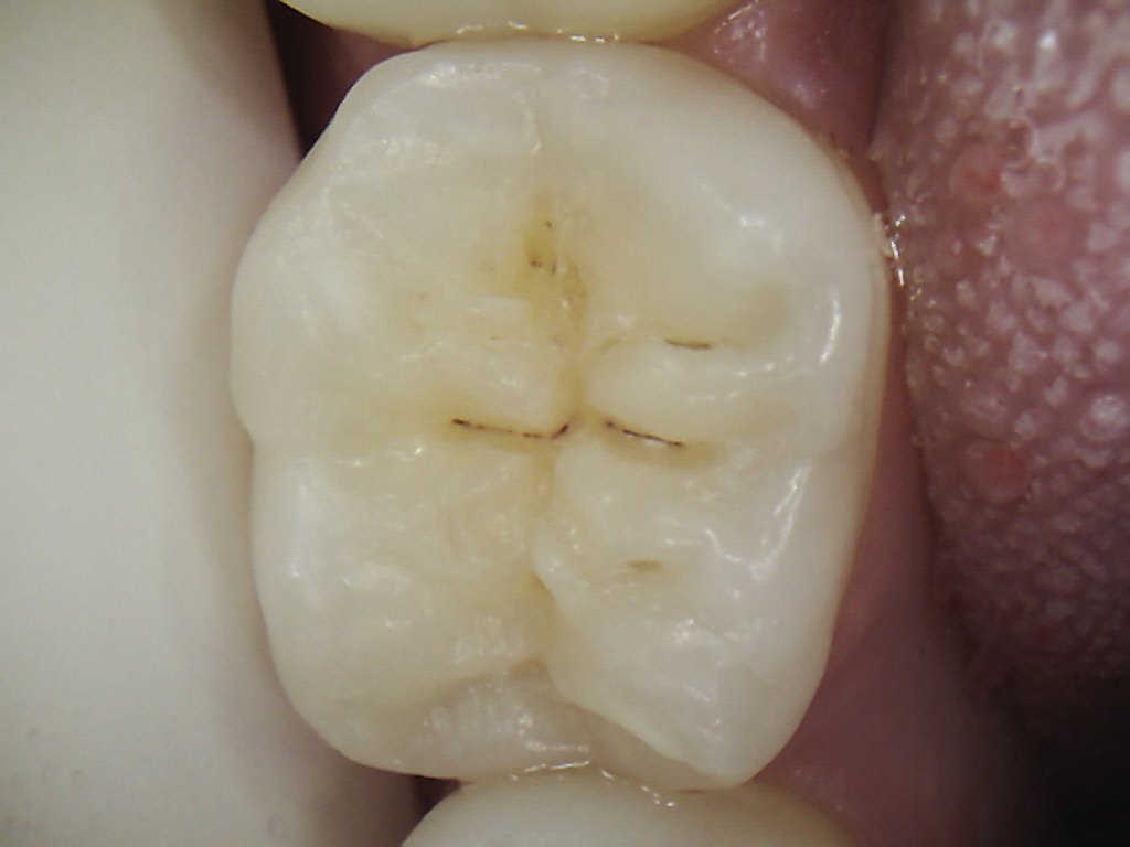 Fissure Protection & PRRs | Discover Dental Wellington