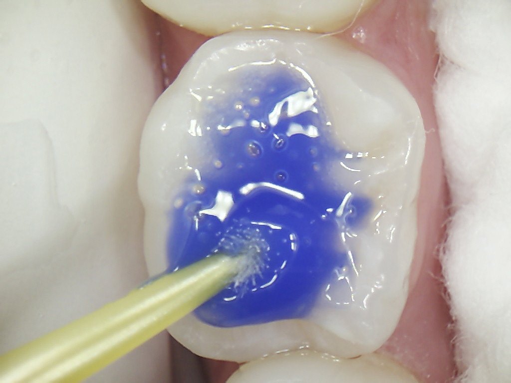 Fissure Protection & PRRs | Discover Dental Wellington