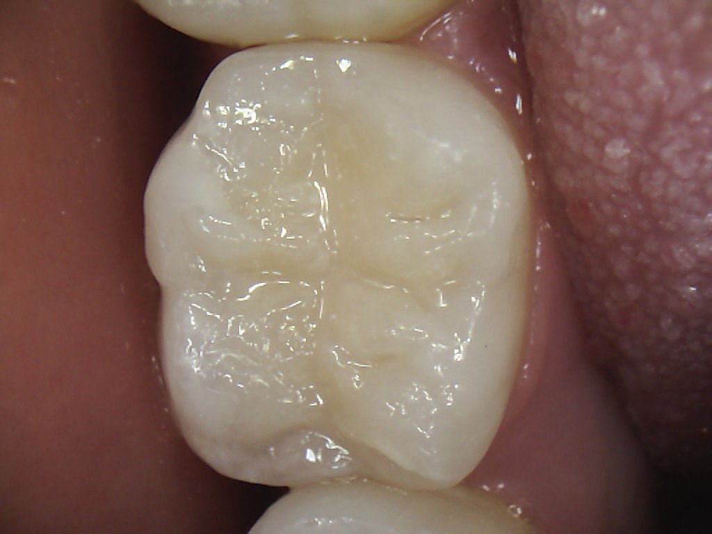 Fissure Protection & PRRs | Discover Dental Wellington