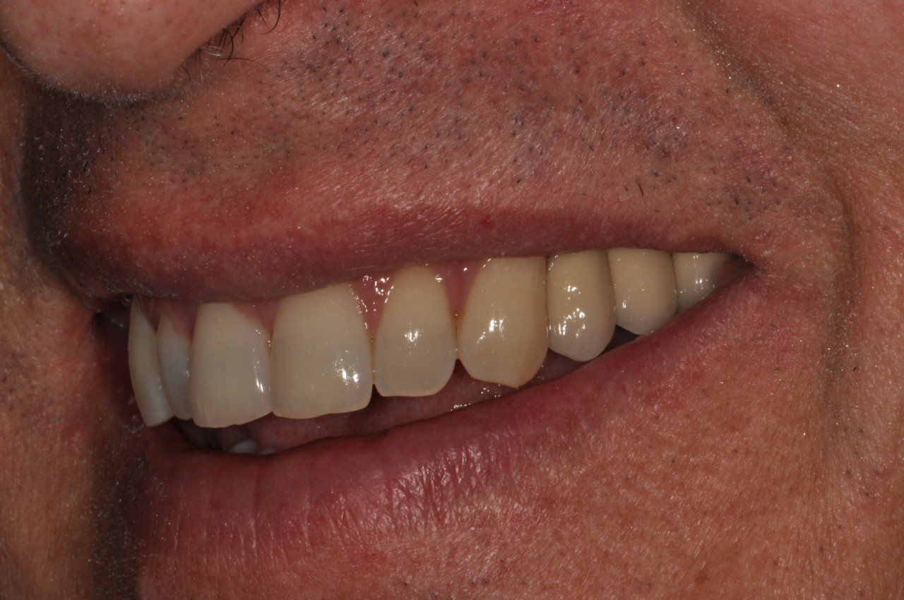 Implant Supported Teeth | Discover Dental Wellington