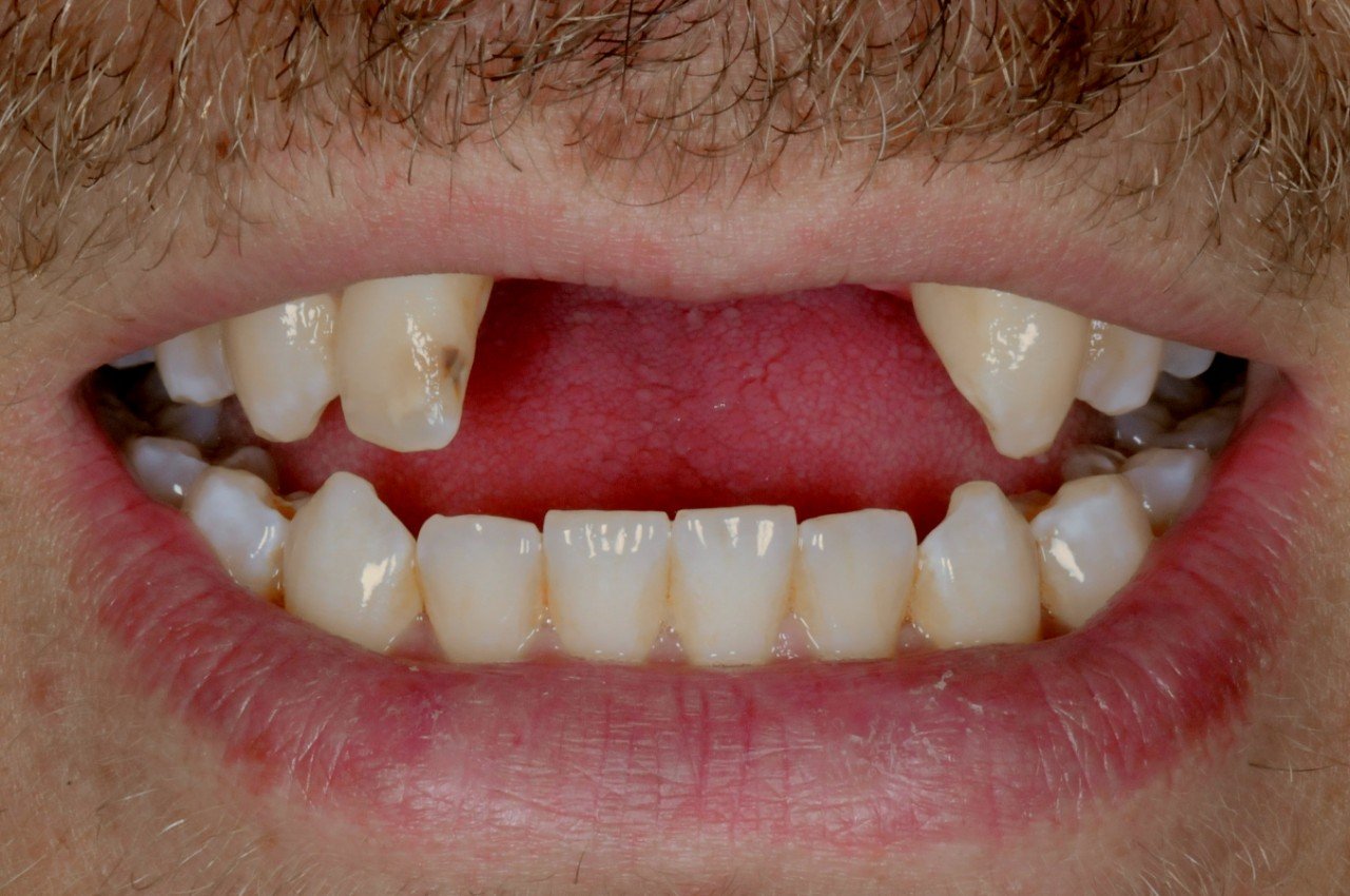 Implant Supported Teeth | Discover Dental Wellington