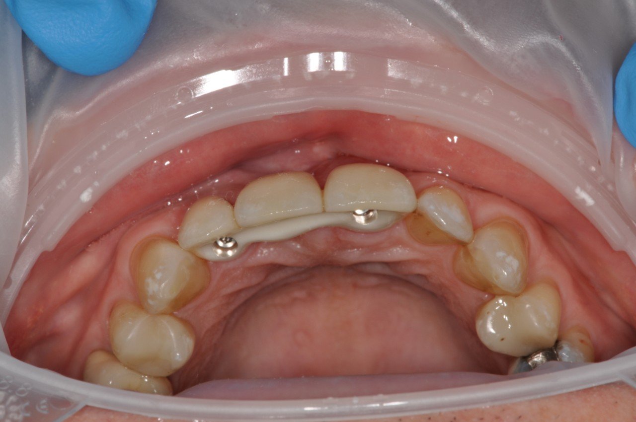 Implant Supported Teeth | Discover Dental Wellington