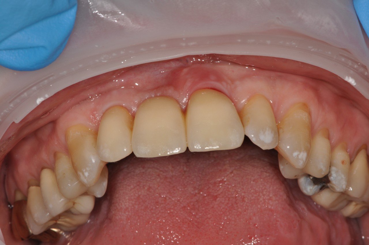 Implant Supported Teeth | Discover Dental Wellington