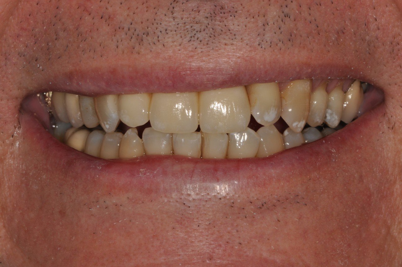 Implant Supported Teeth | Discover Dental Wellington