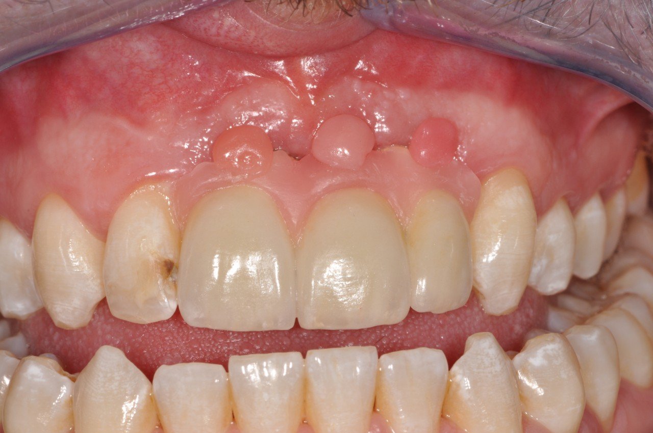 Implant Supported Teeth | Discover Dental Wellington