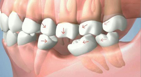 Implants & Missing Teeth | Discover Dental Wellington