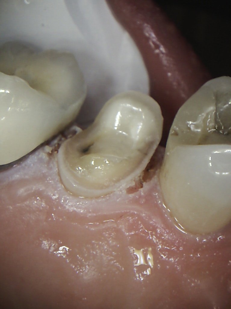 Crowns & Onlays | Discover Dental Wellington