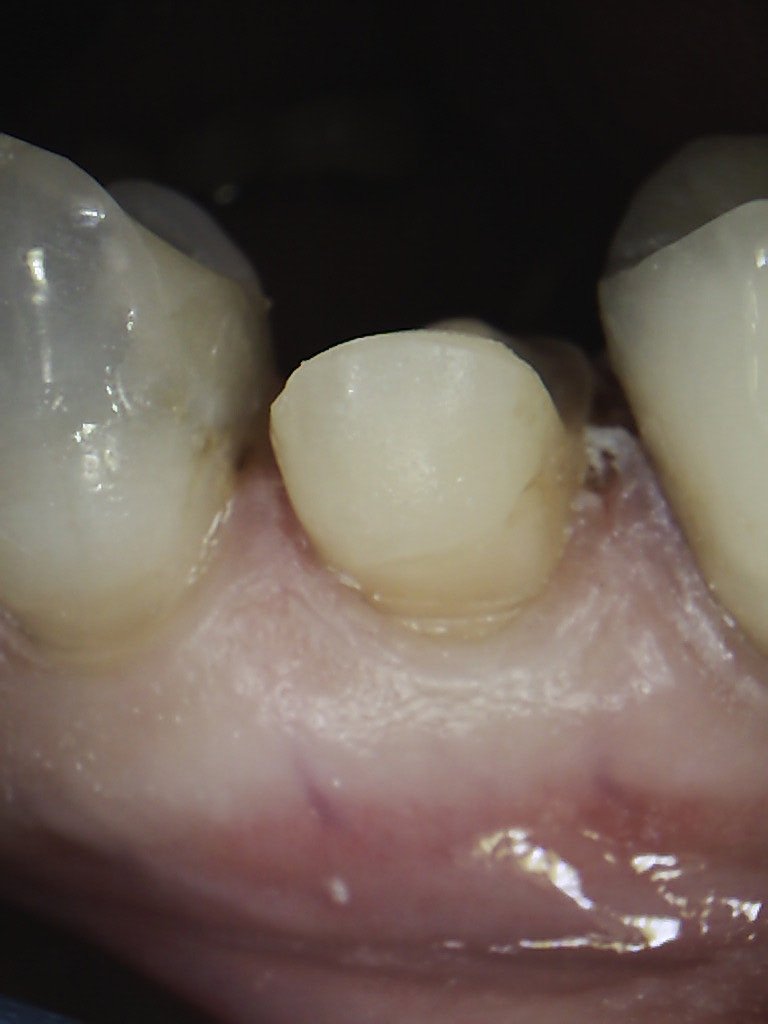 Crowns & Onlays | Discover Dental Wellington