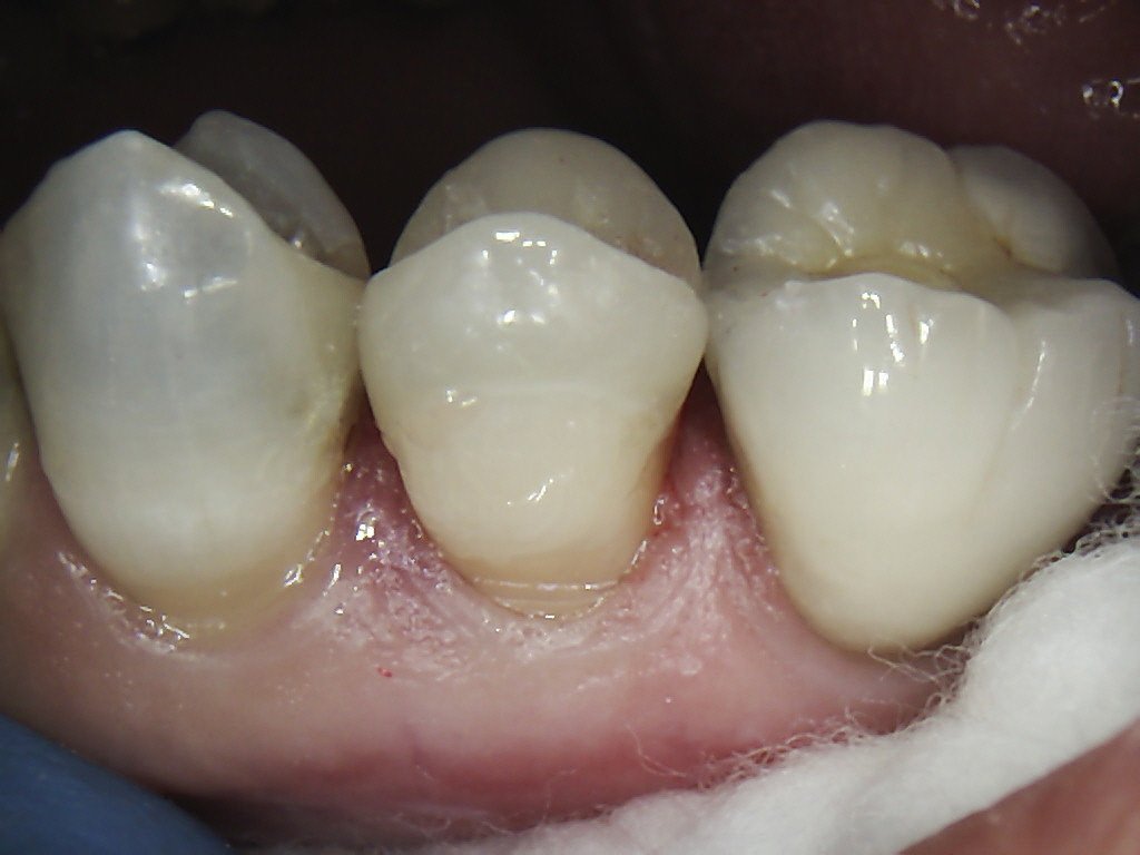 Crowns & Onlays | Discover Dental Wellington